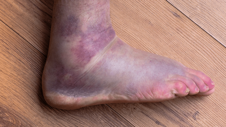Discolored Skin on Legs - Pinnacle Vein & Vascular Center